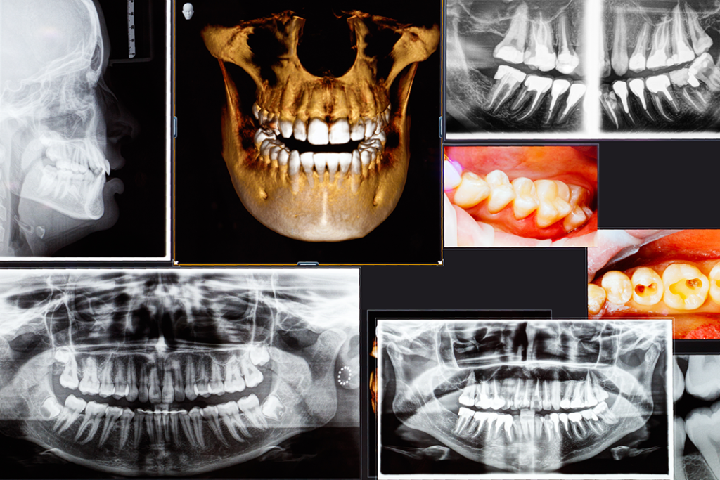 The Paradigm Shift: 3D Cone Beam Computed Tomography Scan - Today's RDH