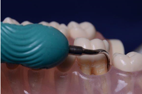 Smart Scaling – For a Better Patient Experience - Today's RDH