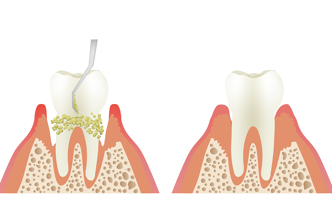 The Education Process of Prophylaxis vs. Scaling and Root Planing ... The Education Process of Prophylaxis vs. Scaling and Root Planing ...