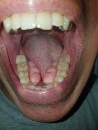 A Patient’s Story of Tori Removal - Today's RDH