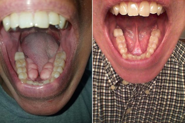 A Patient’s Story of Tori Removal - Today's RDH