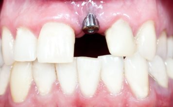 New AAP Periodontal Classification Guidelines - Today's RDH