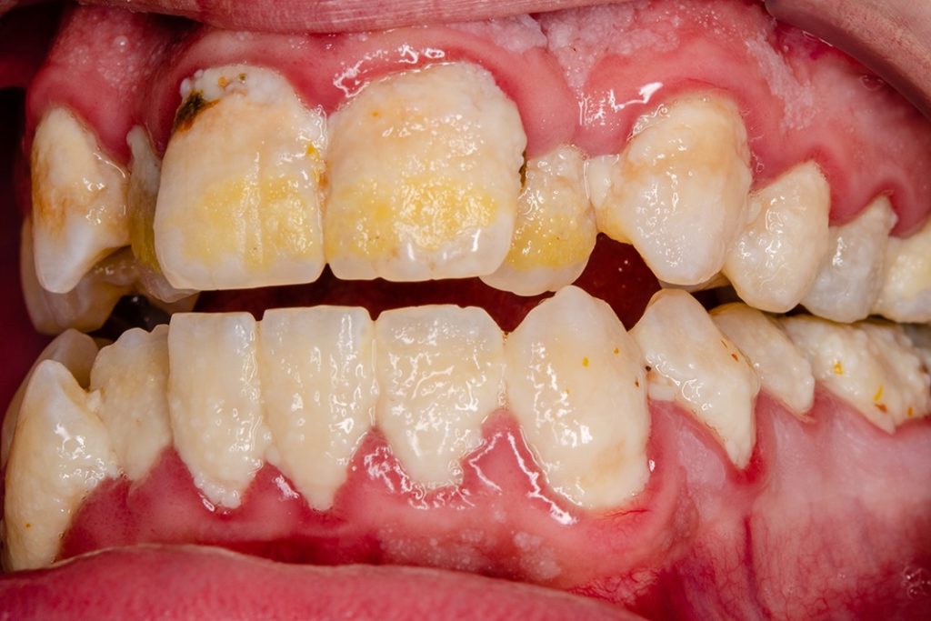 The Oral Bacteria Prevotella intermedia and its Link to Gout and ...