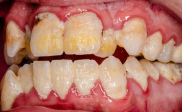 New AAP Periodontal Classification Guidelines - Today's RDH