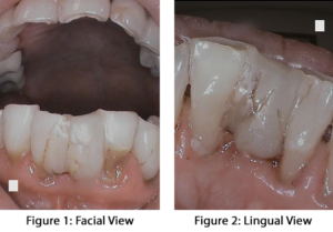 A Look at Pontic to Natural Tooth Bridges - Today's RDH