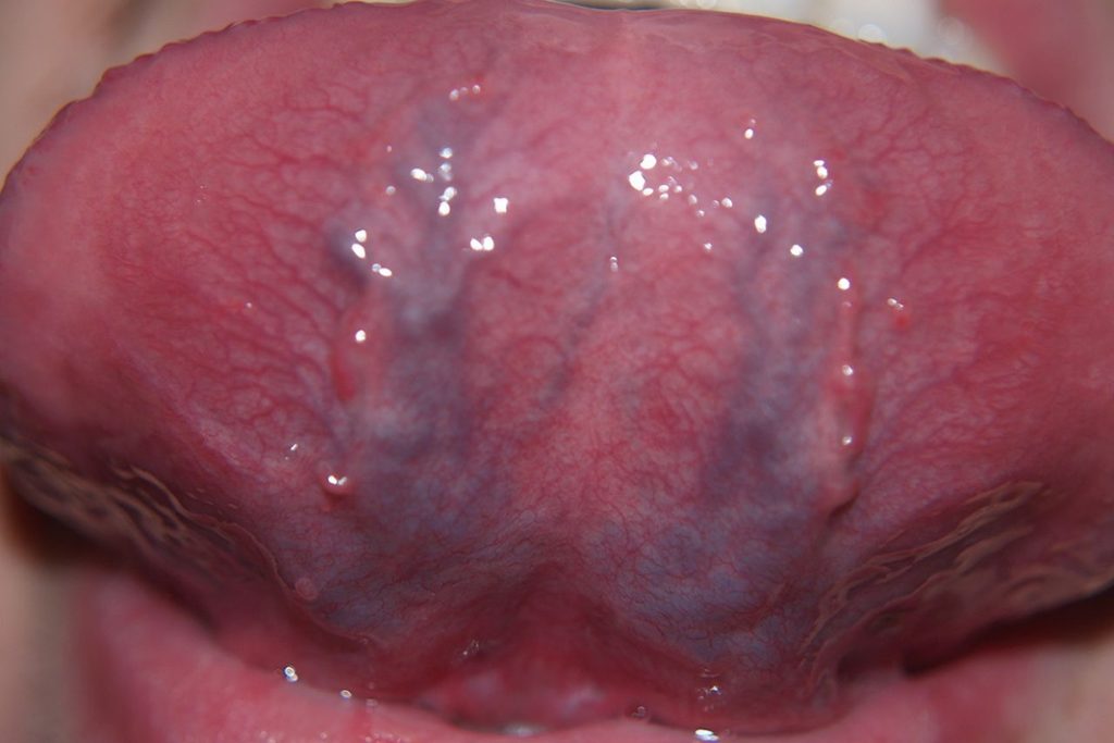 Lingua Del Caviale I Pazienti Di Igiene Dentale Mostrano Segni Di 