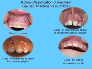 Frenums: Checking for Frenum Abnormalities During Oral Hygiene Exams ...