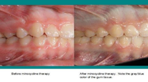 Tooth Staining: Awareness of Oral Health Effects of Tetracycline and ...