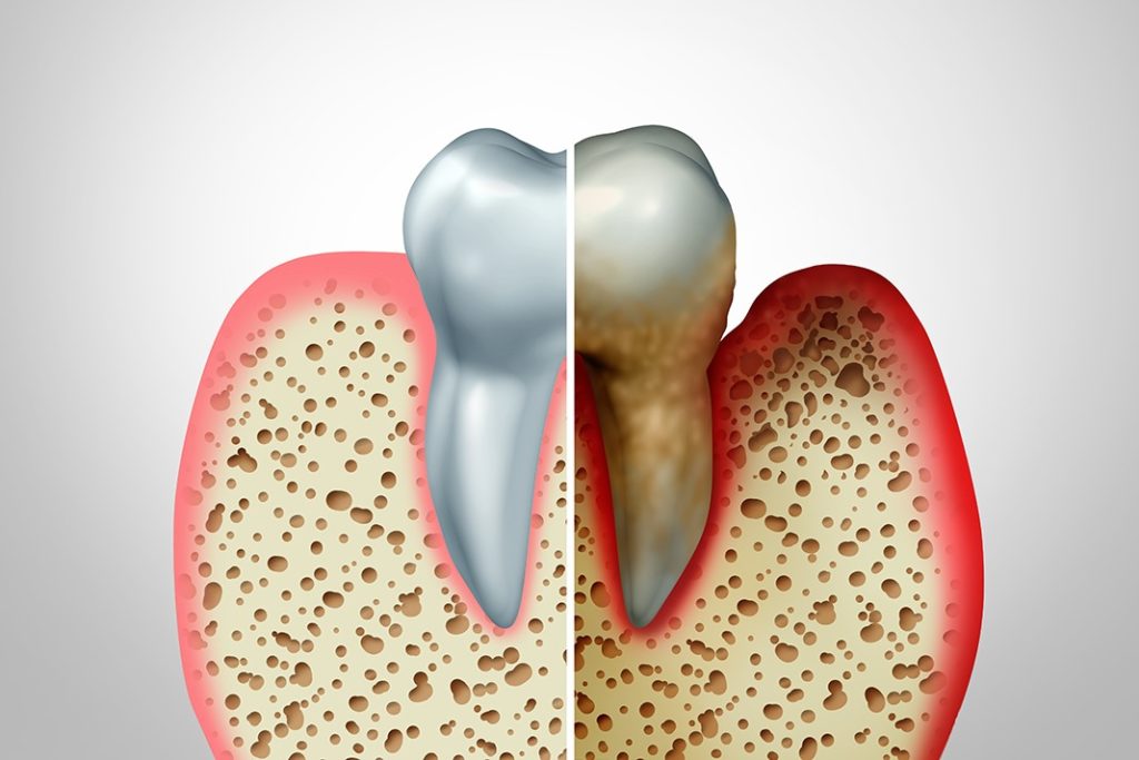 Visual Aids Showing Severe Periodontitis Shown to Motivate ...