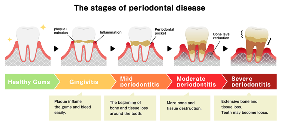 Visual Aids Showing Severe Periodontitis Shown to Motivate ...