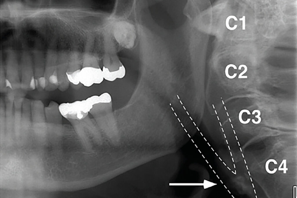 Panoramic and 3-Dimensional Images: Can they Detect Potential Carotid ...