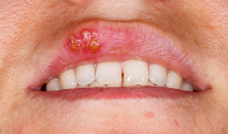 Stomatitis: How Dental Professionals Treat and Manage these Conditions ...