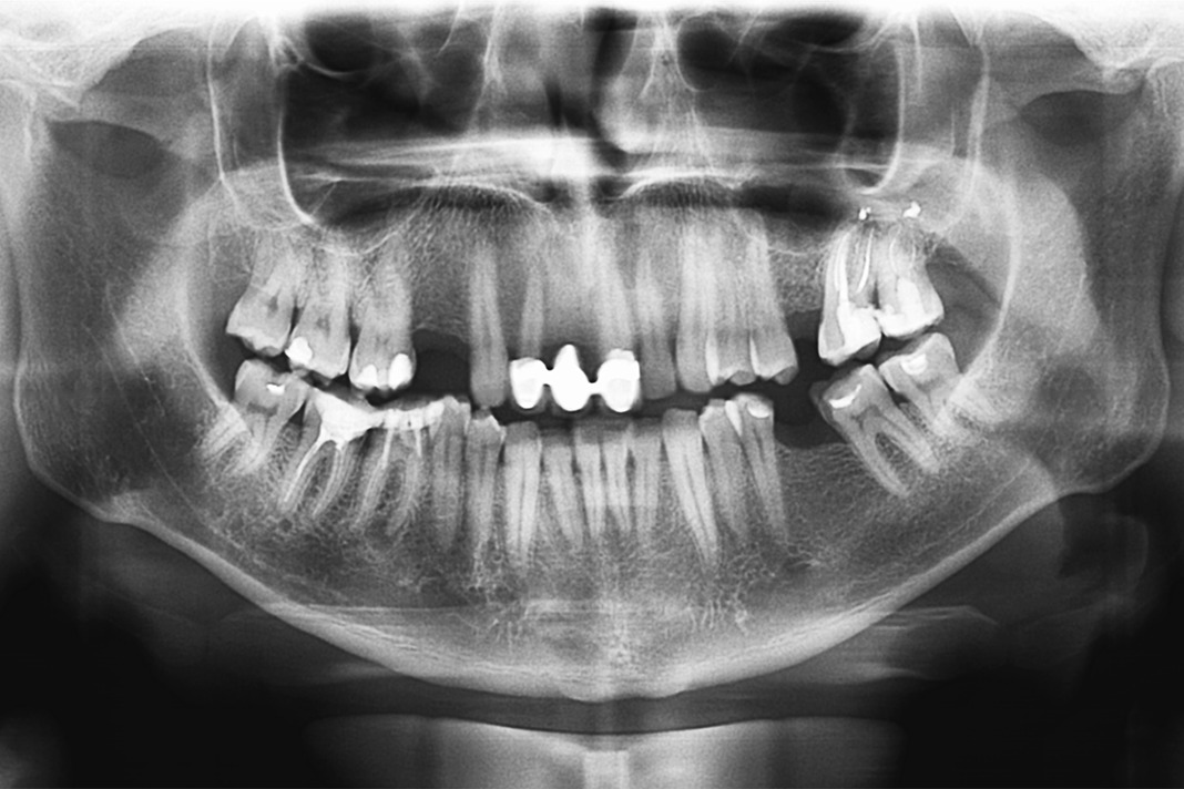 Research Shows Panoramic Radiographs' Ability to Diagnose Bruxism via ...