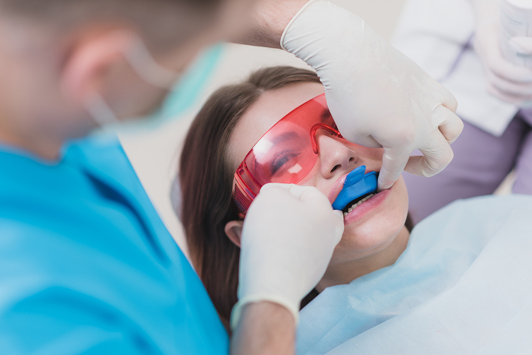 Stannous Vs Sodium Fluoride When Dental Professionals Should