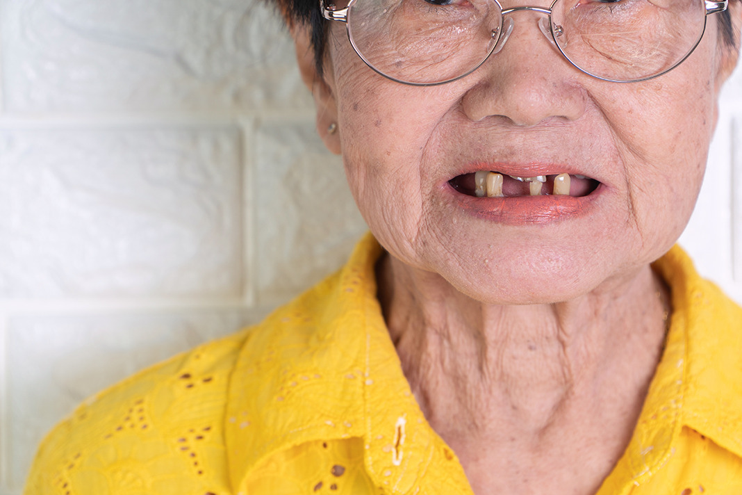 Longitudinal Look at Tooth Loss and Cognitive Decline among Older ...